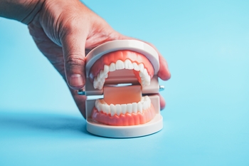 What Are Immediate Dentures? Benefits, Procedure, & Costs